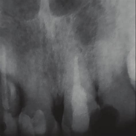Pdf Horizontal Root Fracture In The Apical Third Case Report
