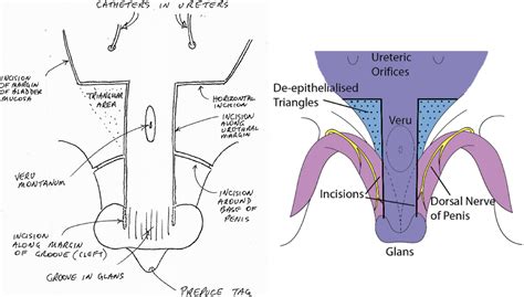 Justin H Kelly And His Procedure For Bladder Exstrophy And Epispadias