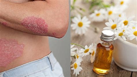 Leczenie luszczycy domowymi sposobami leczenie homeopatyczne łuszczycy skóry rąk i głowy YouTube