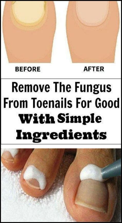 9 Simple Ingredients To Remove The Fungus From Toenails Healthcare Important