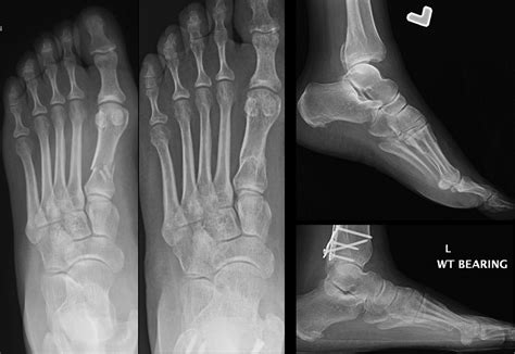 4th Metatarsal Fracture