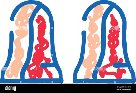 Human Tonsil Anatomy Showing Infection And Inflammation Stock Vector