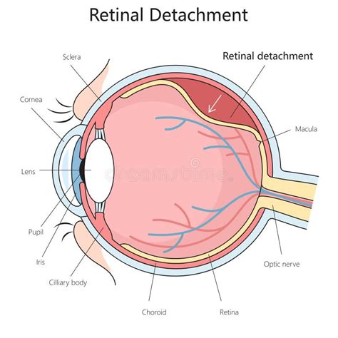 Retinal Detachment Diagram Medical Science Stock Illustration