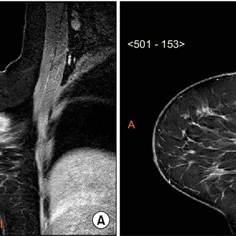 Pdf Intramammary Sentinel Lymph Node With Capsular Extravasation In