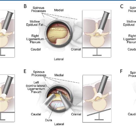 A Tubular Placement For A Right Sided Approach Under The Microscope