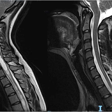 Duraplasty After Suboccipital Decompression In This Case A Small
