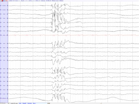Juvenile Myoclonic Epilepsy Eegpedia