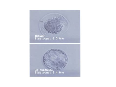 Top 10 Facts About The Use Of Methotrexate To Treat Ectopic Pregnancy