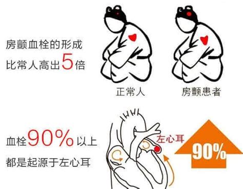 房颤严重吗房颤危害有哪些还能活多久 心脏