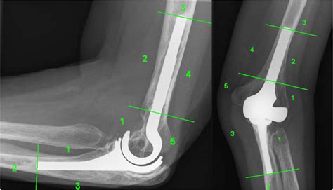 Classification Of Radiological Analysis As Described By Wagener Et Al Download Scientific Classification Of Radiological Analysis As Described By Wagener Et Al Download Scientific