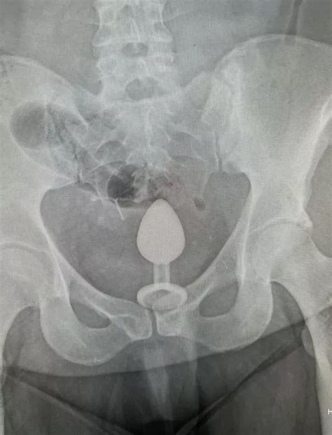 I Tried Sex Toy To Spice Things Up But It Got Stuck Hot Nurse Had To Fish It Out Daily Star