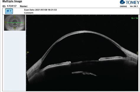 Anterior Segment Oct In The Right A And Left B Eyes Download Scientific Diagram