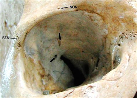 Anterior View Of The Right Orbit With Two Meningo Orbital Foramen