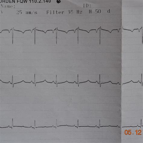 Electrocardiography With Prolonged QT Interval 467msn Download Scientific Diagram