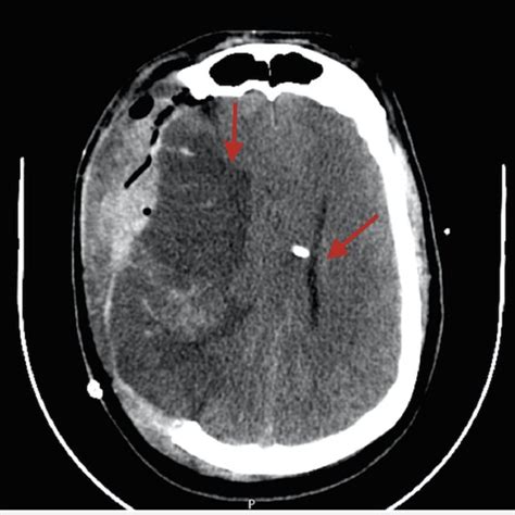Cerebral Ct Scan Showing Ischemic Infarction In The Territory Of The