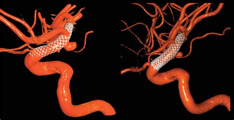 Figure 2 From Device On Aneurysm Occlusion Rate And Recoil Of The Pipeline Embolization Effect