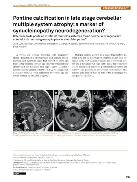 Pdf Pontine Calcification In Late Stage Cerebellar Multiple System