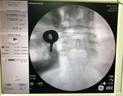 『以管窺天』 以前媽媽都叫我們不要盯著電視看 不然以後會近視🤓 骨科鍾玉軒醫師 脊椎內視鏡 X 微創