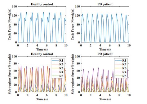 A Novel Plantar Pressure Analysis Method To Signify Gait Dynamics In Parkinsons Disease