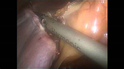 Left Lateral Sectionectomy For Metastatic Liver Tumor By Mustafa Kerem Md Youtube