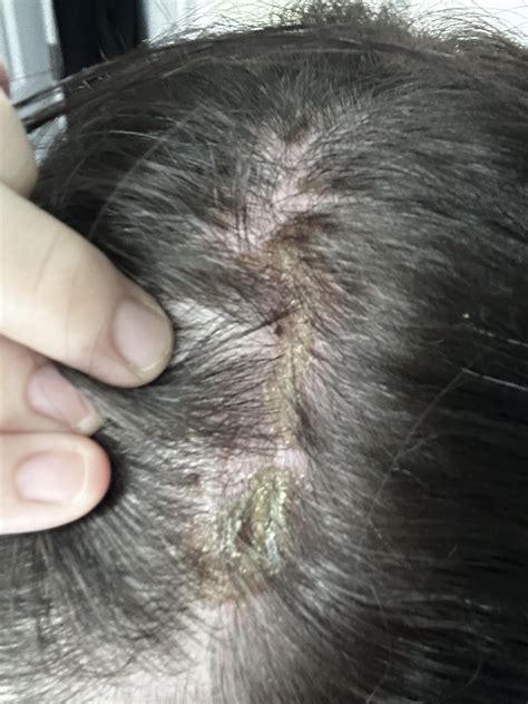 Picking Scalp Causing Scabs Need Help R Calmhands