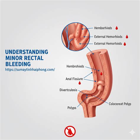 Understanding Minor Rectal Bleeding A Comprehensive Guide To Causes