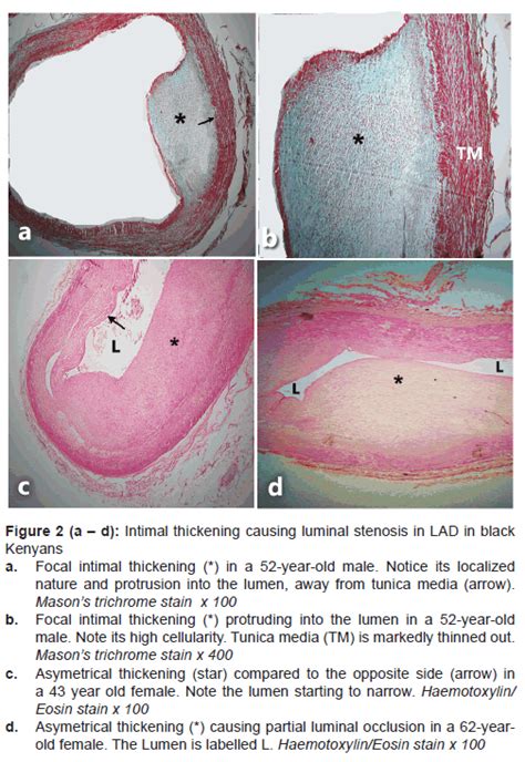 What Is Luminal Narrowing Definition At James Goldsbrough Blog
