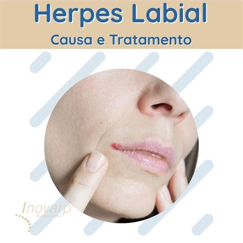 Herpes Labial Inovarp Dra Claudia Bustamante