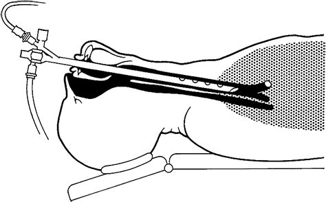 Jet Ventilation Video At Declan Thwaites Blog