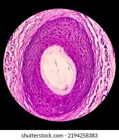 Cutaneous Calcification Images Stock Photos Vectors Shutterstock