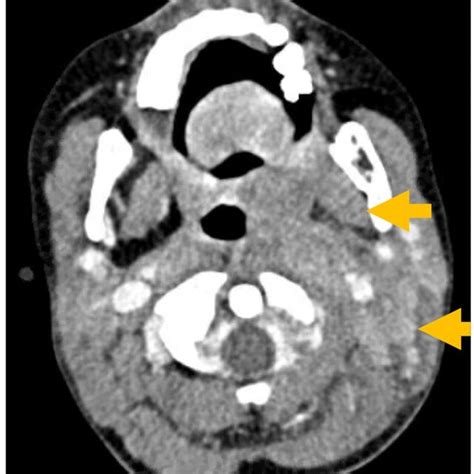 Ct Taken On Admission Showing Enlargement Of The Left Palatine Tonsil