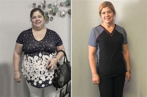 Miami Weight Loss Surgery Center Moon Gastric Sleeve