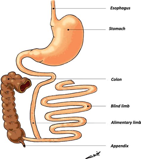 Jejuno Ileal Bypass Varco 1953 Download Scientific Diagram