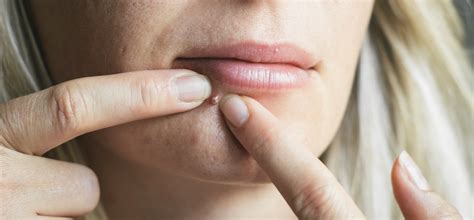 Should You Pop A Pimple Or Leave It Alone Hum Nutrition Blog