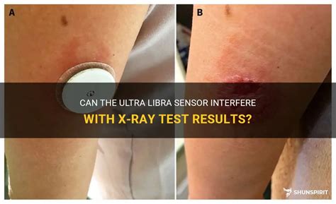Can The Ultra Libra Sensor Interfere With X Ray Test Results Shunspirit