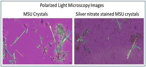 Uric Acid Crystals Polarized