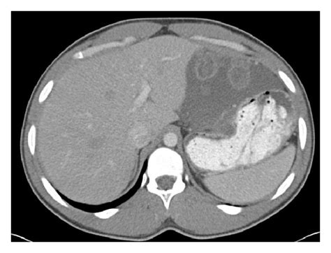 Computed Tomography Ct Image Demonstrating The Appearance Of Gastric Download Scientific