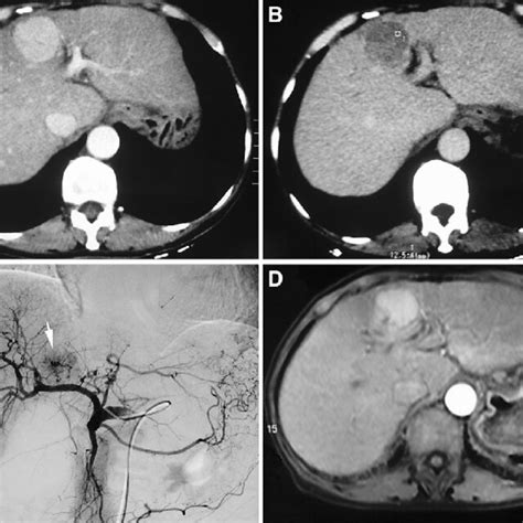 A Contrast Enhanced Ct Scan Revealed A Round Solid Hypodense Mass In