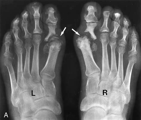 Charcot Joint Neuropathic Arthropathy Diseases And Conditions