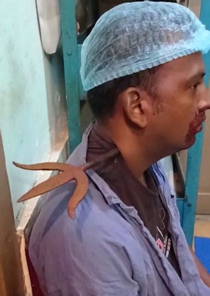 Man Survives Impalement Through Neck With 15 Foot Ancient Trident