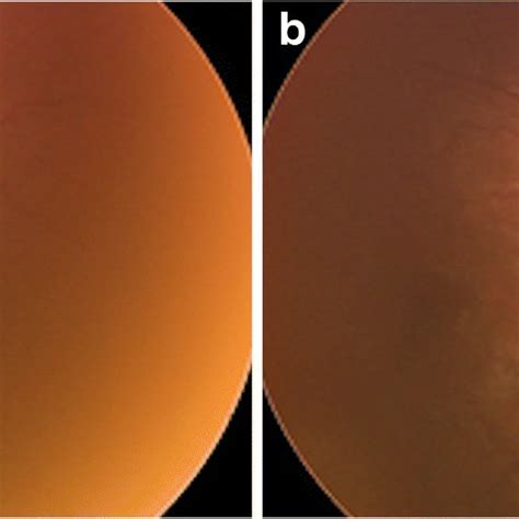 Retinal Hemorrhages On Indirect Ophthalmoscopy And Download Scientific Diagram