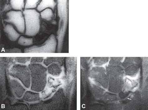 4 Scaphoid Imaging Musculoskeletal Key