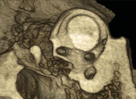 Use Of Cone Beam Computed Tomography In The Diagnosis Of Superior