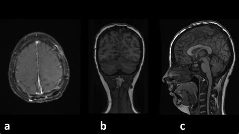 Axial A Coronal B And Sagittal C T1 Weighted Magnetic Resonance