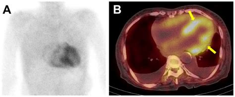 The 99m Tc Dpd Bone Scintigraphy And Single Photon Emission Computed