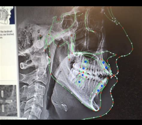 30 40 Cephalometric Imaging And Analysis Product Details Orthotraining