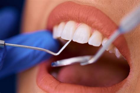 Cómo se hace un Curetaje Dental Qué es