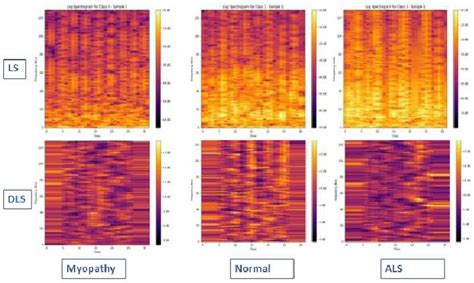 Figure 1 From Emg Signal Classification For Neuromuscular Disorders