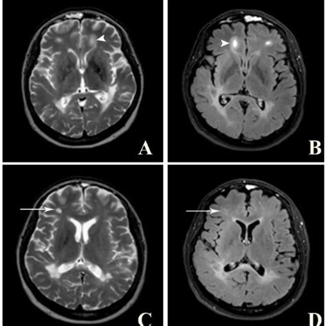 Balos Concentric Sclerosis A And B Axial T2w A And Post Contrast
