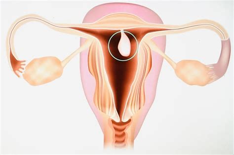 Polyp cổ tử cung và tử cung là gì